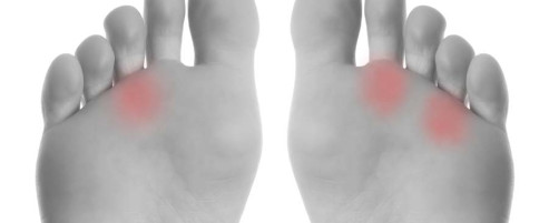 Metatarsalgia: causes, symptoms & treatments Metmer MD. – Orthopedic ...