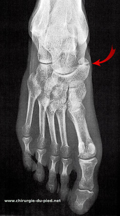 What Is the Accessory Navicular Syndrome? Metmer MD. – Orthopedic Surgeon