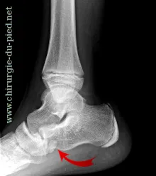 What Is the Accessory Navicular Syndrome? Metmer MD. – Orthopedic Surgeon