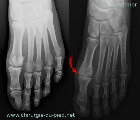 Hallux Rigidus pathologie et intervention chirurgicale Bordeaux Dr ...