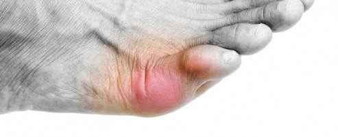 Bunionette, la bosse du petit orteil: le traitement pour soulager votre ...