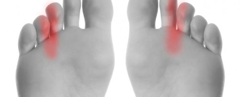 Névrome de Morton - Comment soulager? Dr Metmer – Chirurgien orthopédiste