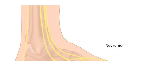 Névrome de Morton - Comment le soulager?